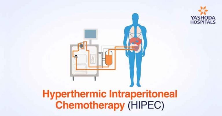 Hyperthermic Intraperitoneal Chemotherapy (HIPEC) for Advanced ...