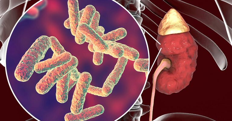 Hemolytic Uremic Syndrome (HUS) - Yashoda Hospitals