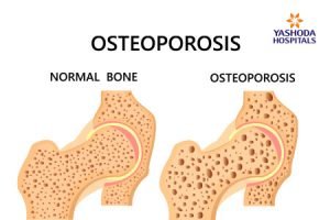 Hypocalcemia: Symptoms and Complications