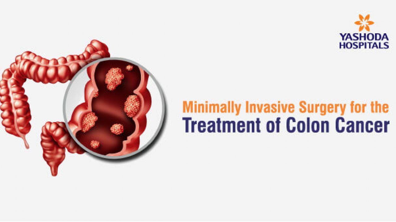 Cecum Cancer Surgery