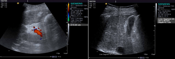 Ultrasound Elastography and MR Elastography for Assessing Liver Fibrosis