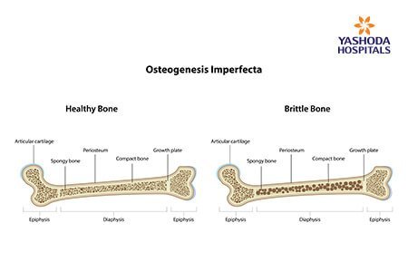 Osteogenesis imperfecta: What is Osteogenesis imperfecta, its Types and ...