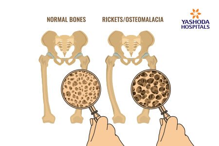 Osteomalacia: What is Osteomalacia, its Causes?