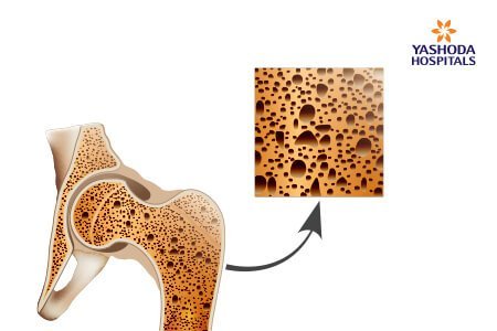 Osteopenia: What is Osteopenia, its Causes?