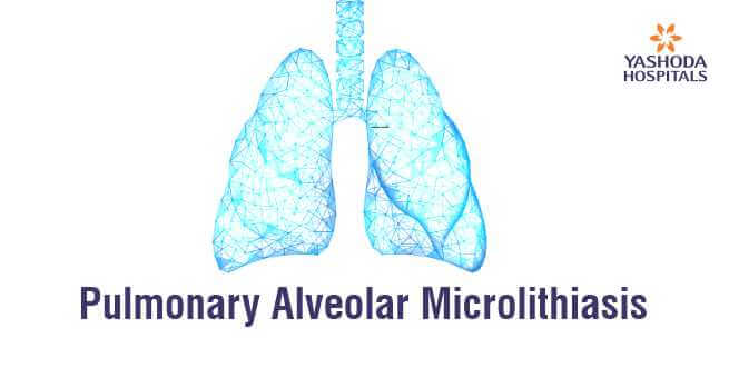 Pulmonary Alveolar Microlithiasis (PAM) || Yashoda Hospitals