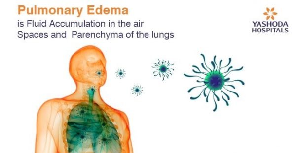 Pulmonary Edema: Excess fluid in the lungs, air spaces and parenchyma ...