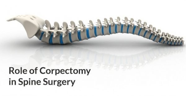 Role of Corpectomy in Spine Surgery at Yashoda Hospitals
