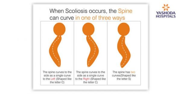 Right Scoliosis: Symptoms, Causes and Treatment