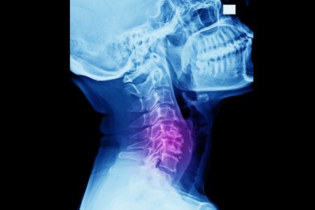 Cervical Spondylotic Myelopathy (CSM): What is Cervical Spondylotic ...