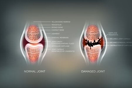 Synovial Joint: Symptoms and Complications