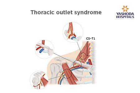 Thoracic Outlet Syndrome: What is Thoracic Outlet Syndrome, its Types ...