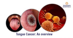Tongue Cancer: Stages, Symptoms, Causes, Diagnosis and Treatment