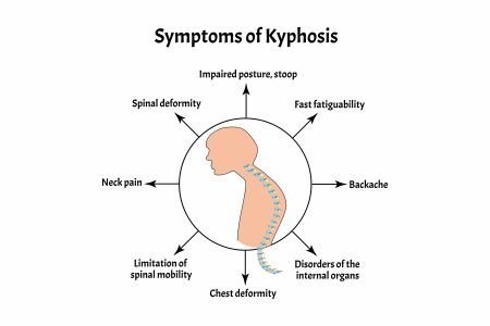 Kyphosis of the Spine: Symptoms, Risk Factors and Complications