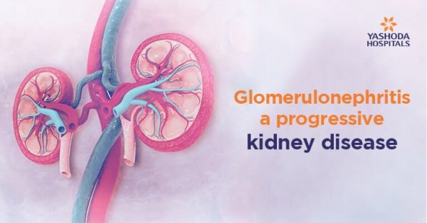 Glomerulonephritis: Causes, Symptoms, Diagnosis and Treatment