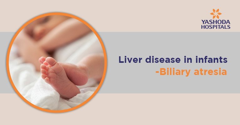 How to treat Biliary atresia, a rare digestive disease in infants?