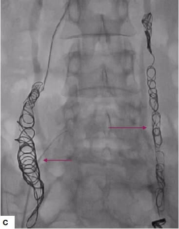 Ovarian vein coil embolization for pelvic congestion syndrome - Yashoda ...
