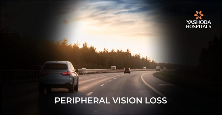Peripheral vision loss: Causes, Diagnosis, Prevention and Treatment