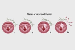 Throat Cancer: Types Causes Symptoms Diagnosis and Treatments