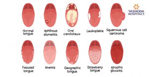 Tongue Cancer: Stages, Symptoms, Causes, Diagnosis and Treatment
