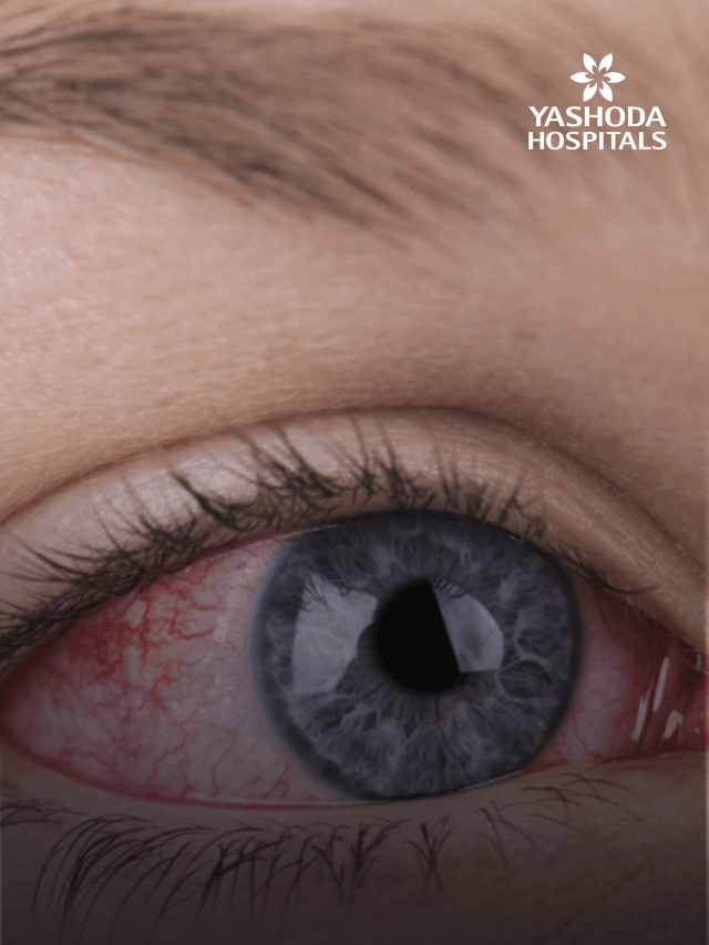 Pink Eye Conjunctivitis: Your Guide to Eye Health and Care