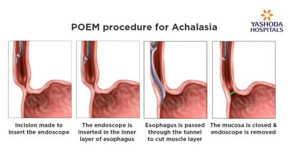 Peroral Endoscopic Myotomy (POEM) for Achalasia