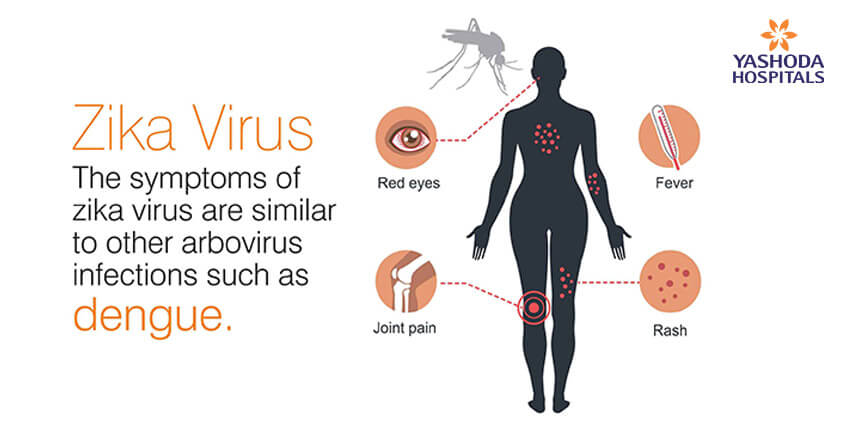 Zika virus - Zika or Zee-ka is a mosquito borne viral disease